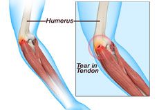 Tennis Elbow Treatment Texas City TX | Lateral Epicondylitis Galveston County, League City TX